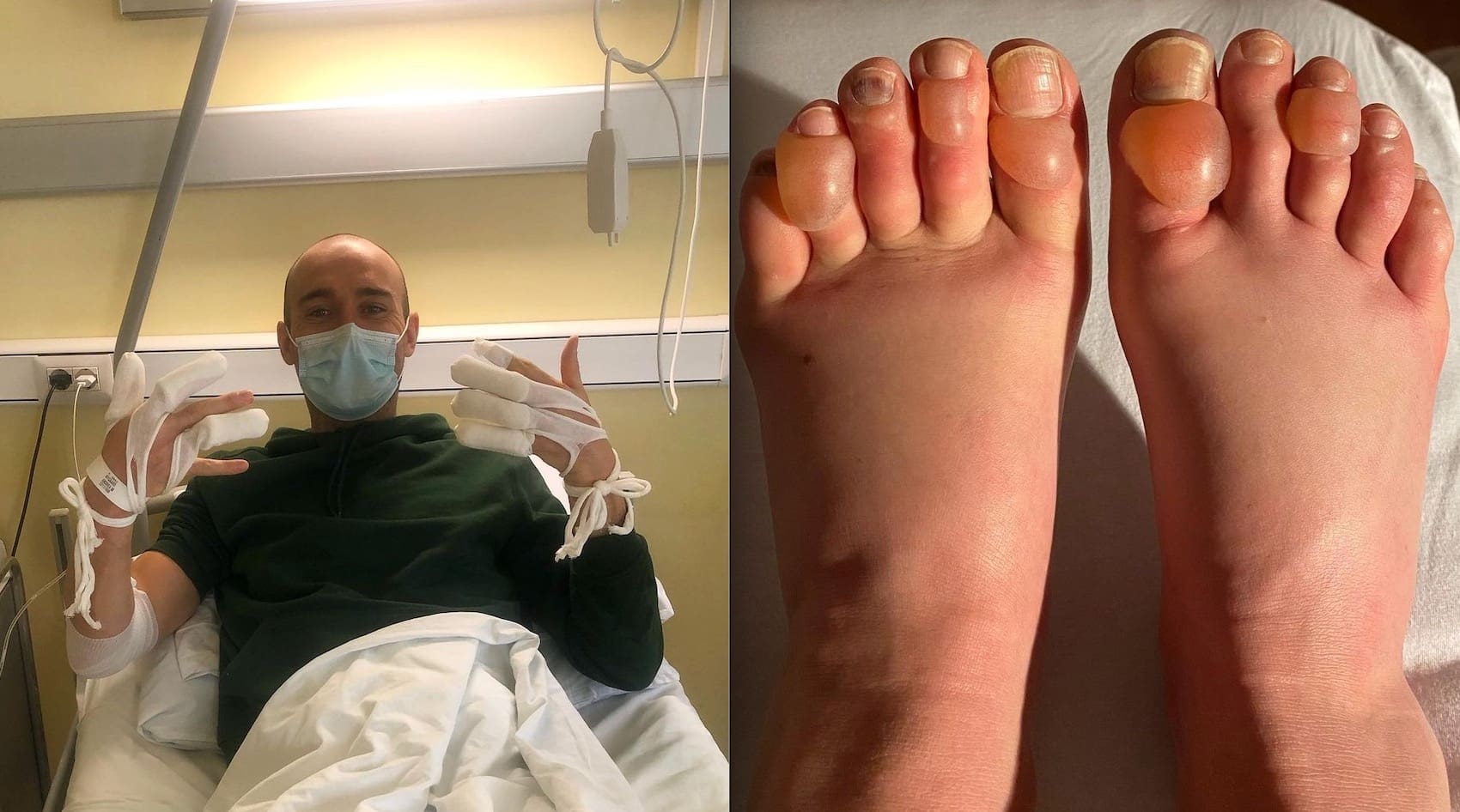 Nordic Skiers Face Frostbite Amputation After 60km Race @ -18F